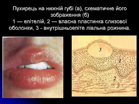 Будова та функції Cлизової оболонки порожнини рота первинні та вторинні елементи ураження