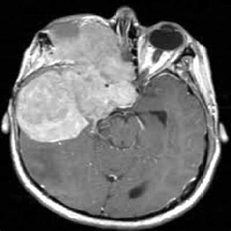 Brain Tumor Detector 4 Classification Model By Brain Tumor Detection