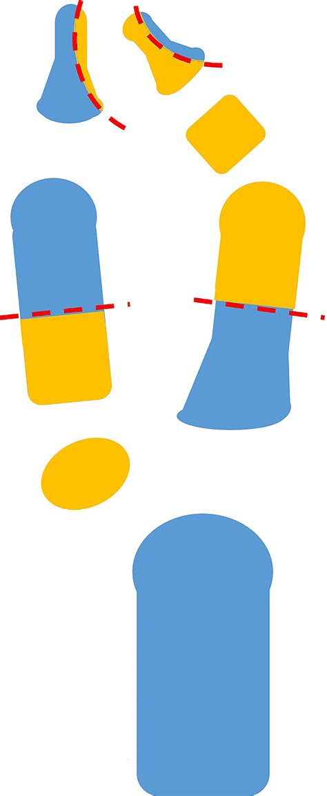 Atypical Radial Polydactyly Surgery — Drweird Buymeacoffee