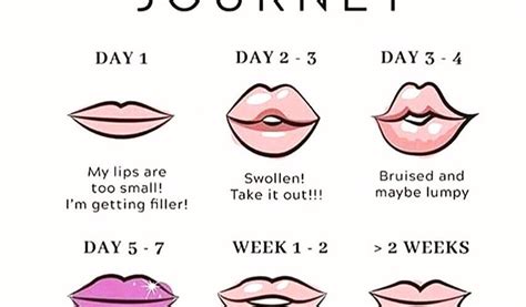 How Long Does Swelling Last After Lip Filler The Daily Glimmer