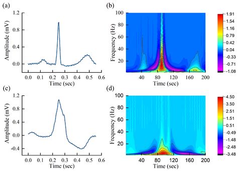 Automatic Ecg Classification Using Continuous Wavelet Transform And Convolutional Neural Network