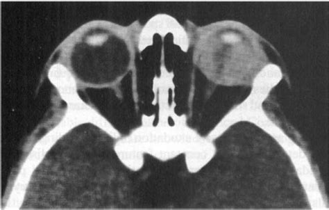 Case 2 C T Scan Demonstrating Increased Density In The Right Globe Download Scientific