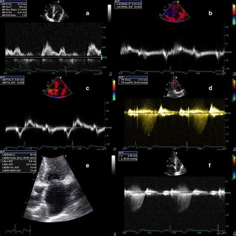 Algorithm For Diagnosis Of Lv Diastolic Dysfunction In Subjects With Download Scientific
