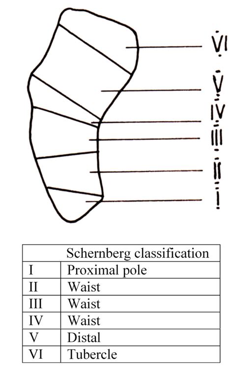 Schernbergs Scaphoid Classification 32 I Proximal Pole Ii Iii