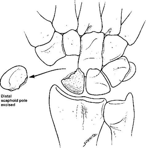 Figure From Proximal Row Carpectomy Semantic Scholar
