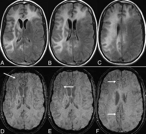 On Axial Flair Images A C Multifocal Pml Lesions Are Observed In