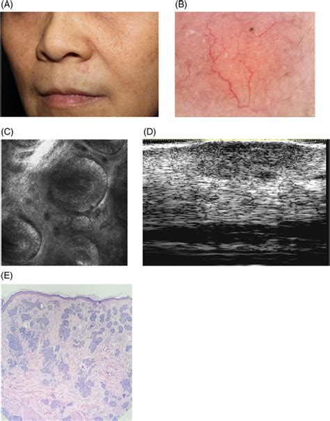 A A Single Skin‐colored Nodule On The Upper Lip B Dermoscopy Download Scientific Diagram