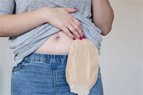 Colostomy Bag For Ileostomy Surgery