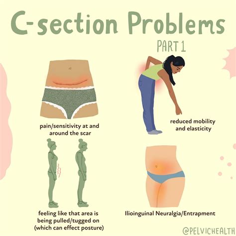 C Section Problems And Solutions From A Pelvic Floor Physical Therapist Artofit