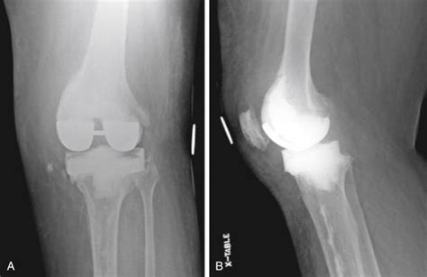 Two Stage Revision Clinical Tree