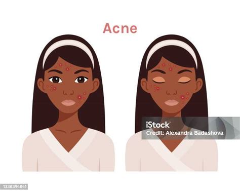 얼굴에 여드름을 가진 아프로 흑인 여자 문제 피부에 여드름 귀여운 여자의 초상화 얼굴 피부 트리트먼트 의료 의료 및 아름다움을위한 유행 일러스트 플랫 만화 스타일 벡터