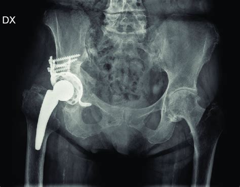 X Ray After Acetabular Revision Surgery Pelvis AP View Download Scientific Diagram