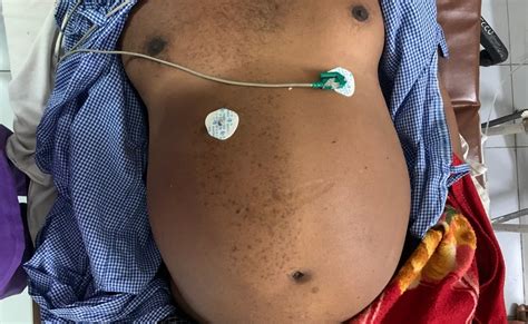 57 Yr Male With Decreased Urine Output