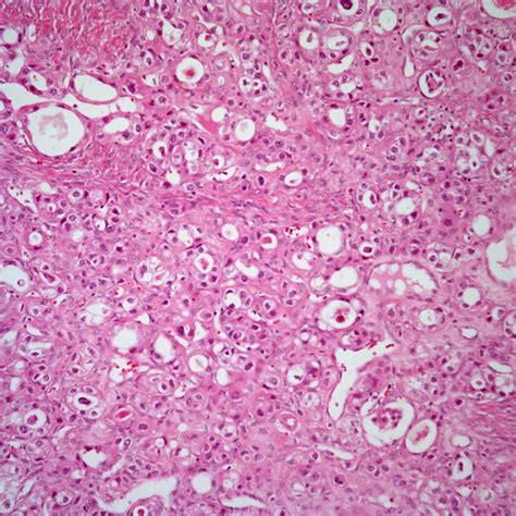 Hipec Cytoreduction Produces Long Term Survival In Advanced Ovarian Cancer