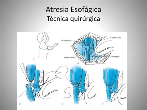 Ppt Atresia EsofÁgica Powerpoint Presentation Free Download Id2195906