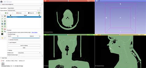 Threshold Is Not Working In Attached Dicom Data Support 3d Slicer Community
