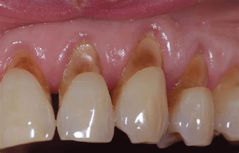 Abfraction Symptoms Causes And Treatment Atlas Dental