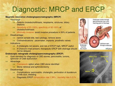PPT Cholangitis Management Of Choledocholithiasis PowerPoint Presentation ID