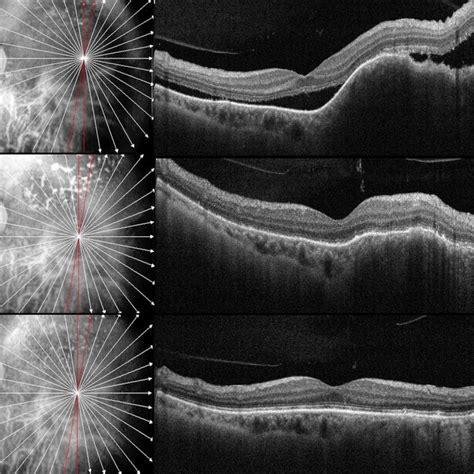 Serial Optical Coherence Tomography Oct Of Our Patient With Choroidal