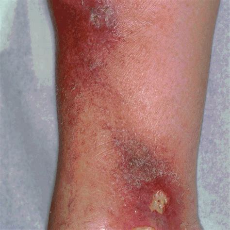 Initial Ulcers Diagnosed As Pyoderma Gangrenosum Fig 2 Initial Download Scientific Diagram