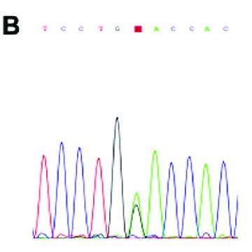 Electropherograms Representative Electropherogram Of A Normal