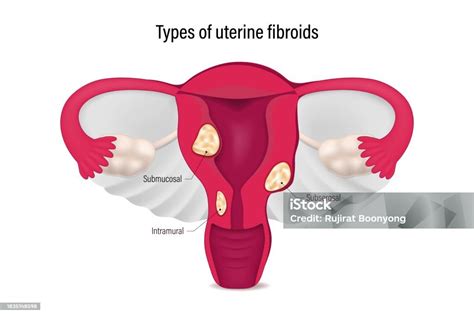 Jenis Fibroid Rahim Fibroid Submukosa Subserosal Dan Intramural Sistem