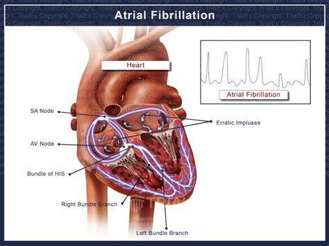 Atrial Fibrillation TrialQuest Inc