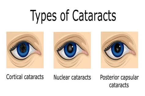What Are Cataracts Definition Symptoms And Causes Of Cataracts Types Risk Factors Diagnosis