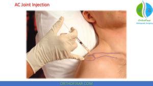 AC Joint Injection Easily Step By Step OrthoFixar