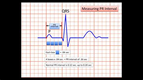 Sample Of Ekg Strip Reading For Web Qt Hd Youtube