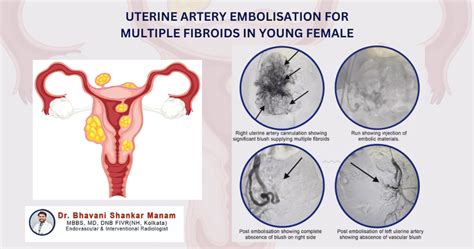 Fibroid Treatment For Young Women Uterine Artery Embolization