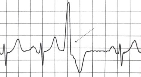 Premature Ventricular Complexes Pvcs Almostadoctor