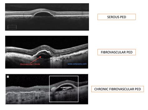 Age Related Macular Degeneration Pptx