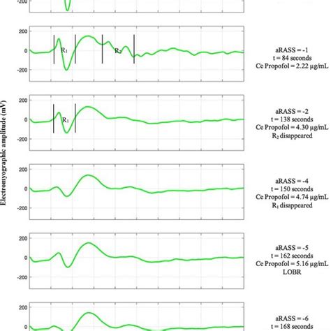 Example Of An Electromyographic Record Of An Electrically Evoked Blink Download Scientific