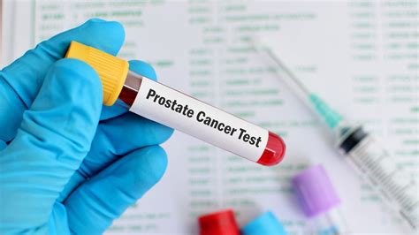 Cáncer de Próstata y Salud Masculina Lo Que Todos Deben Saber Clinica Premium