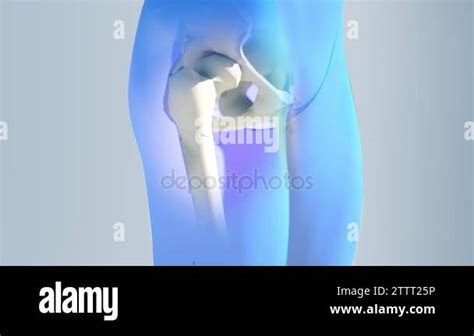 Hip Replacement Implant Installed In The Pelvis Bone Medically