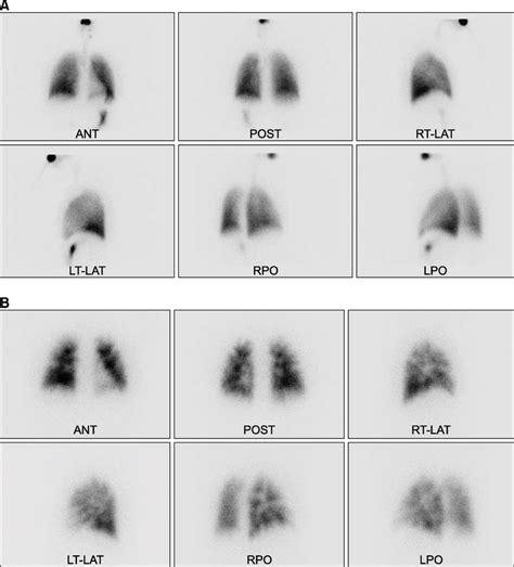 Nuclear Medicine Perfusion Scan Myocardial Perfusion Imaging Mpi Test