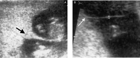 First Trimester Ultrasound Image Of A Fused Dichorionic Placenta With Download Scientific