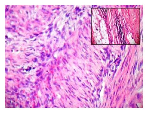 A Benign Mesenchymal Lesion Nodular Fasciitis Cytology Myxoid