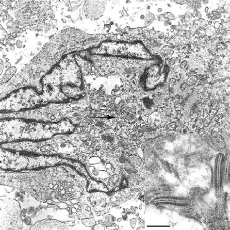 Lung Cat No 1 Diffuse Severe Bronchointerstitial Pattern Download Scientific Diagram