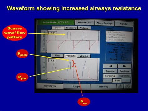 Ppt Ventilator Waveforms Basic Interpretation And Analysis