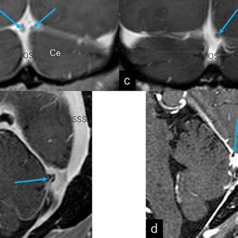 Post Contrast Axial A C And Sagittal B D T1 Weighted Magnetic