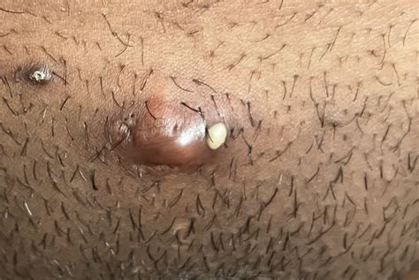 Bouton Au Dessus Du Sexe