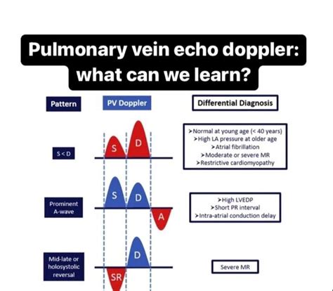 Learn Cardiology On Linkedin Pulmonary Vein Doppler Patterns On Echocardiography