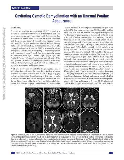 Pdf Cavitating Osmotic Demyelination With An Unusual Pontine Appearance