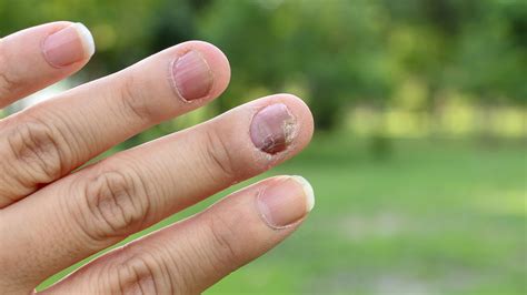 Nail Fungus Remedies To Eliminate Them At Home