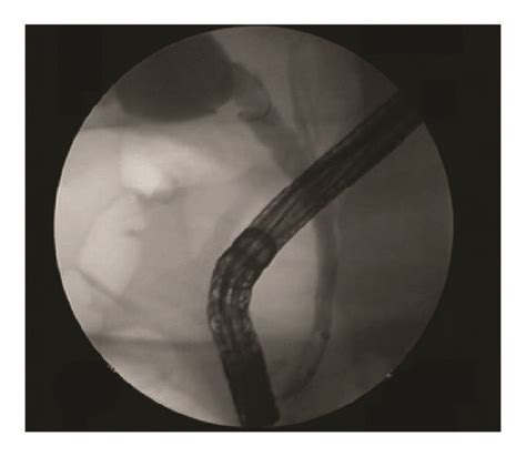Occlusion Cholangiogram After Cystic Duct Stone Removal Download