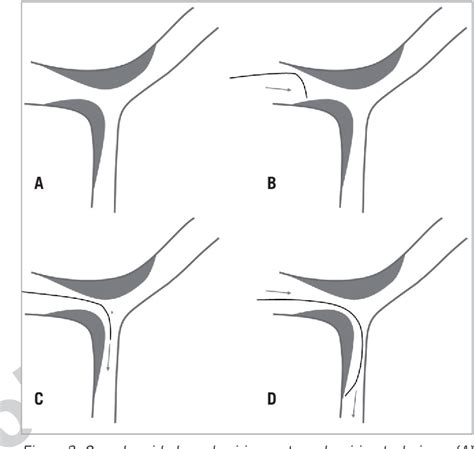 Figure 3 From How To Solve Difficult Side Branch Access Semantic Scholar