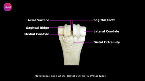 Metacarpals Bones Metacarpals Bones