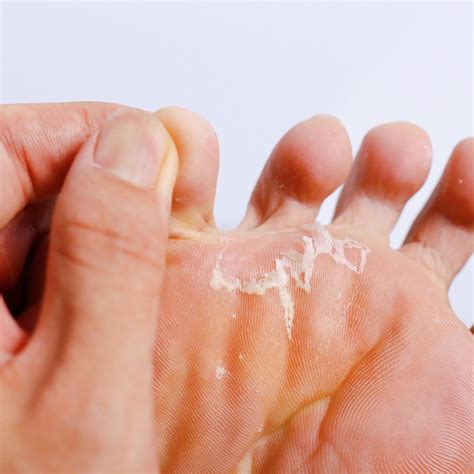 Best Treatment For Fungal Infection